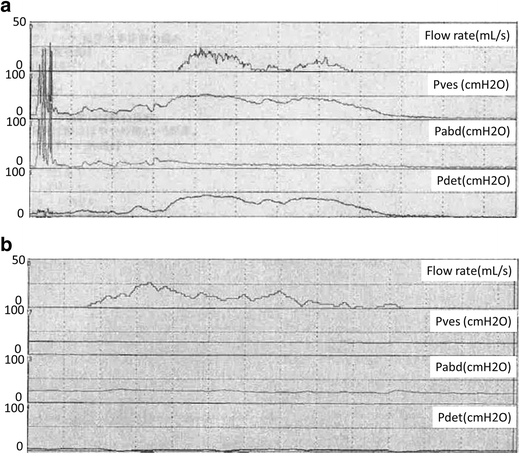 Detrusor pressures in urodynamic studies during voiding in women ...