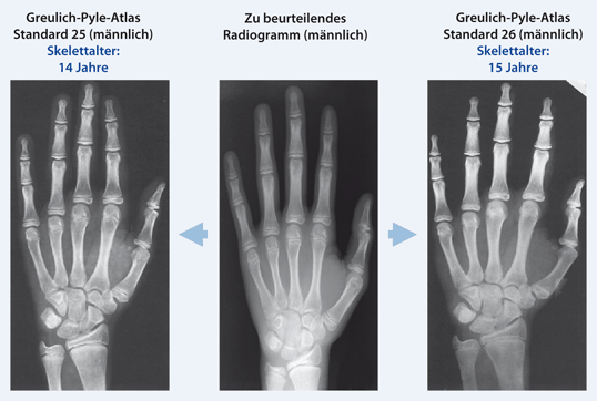 Skelettaltersbestimmung der Hand | SpringerLink