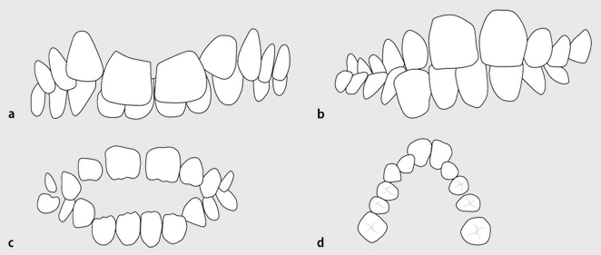 Bissverletzungen und Bissspuren | SpringerLink