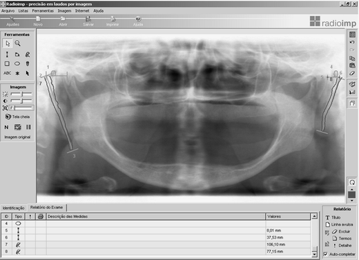 Elongated styloid process and atheroma in panoramic radiography and its ...