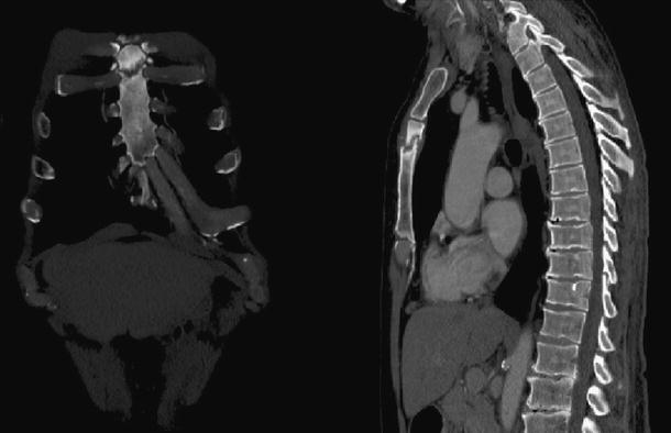Successful treatment of sternal fracture nonunion with teriparatide ...