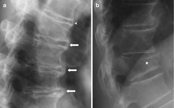 Diffuse idiopathic skeletal hyperostosis (DISH): relation to vertebral ...