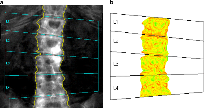 Trabecular bone score (TBS): available knowledge, clinical relevance ...