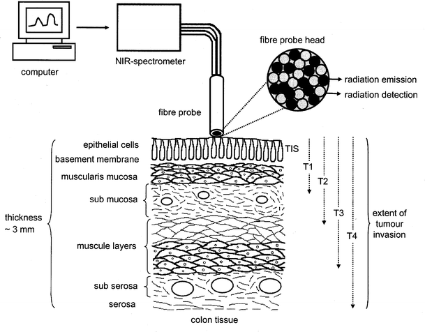 Recent applications of near-infrared spectroscopy in cancer diagnosis ...