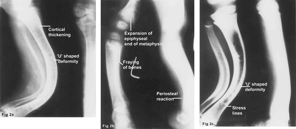 Severe Bone Deformities in Young Children From Vitamin D Deficiency and ...