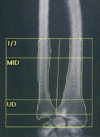 Forearm Bone Mineral Density in Familial Hypocalciuric Hypercalcemia ...