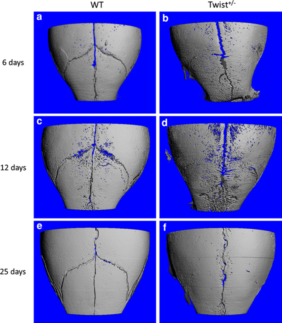 Interrelationship of Cranial Suture Fusion, Basicranial Development ...