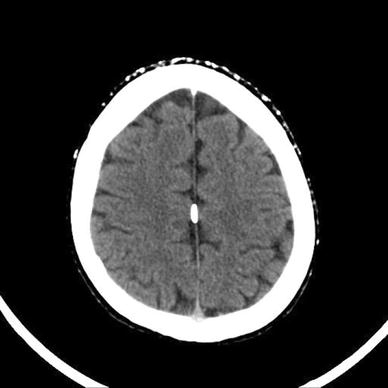 Late-Onset Subcutaneous Scalp Calcifications in a Patient with Pseudo ...