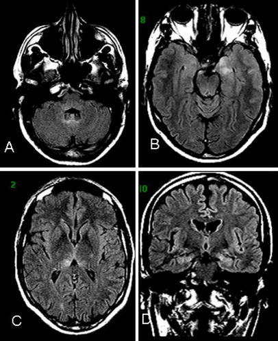 Serial MRI of limbic encephalitis | SpringerLink