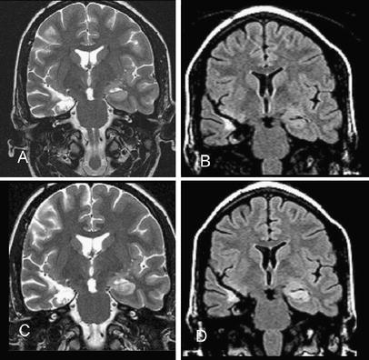 Serial MRI of limbic encephalitis | SpringerLink