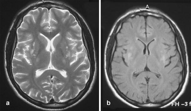 Methanol poisoning: acute MR and CT findings in nine patients ...