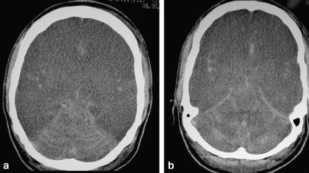 Methanol poisoning: acute MR and CT findings in nine patients ...