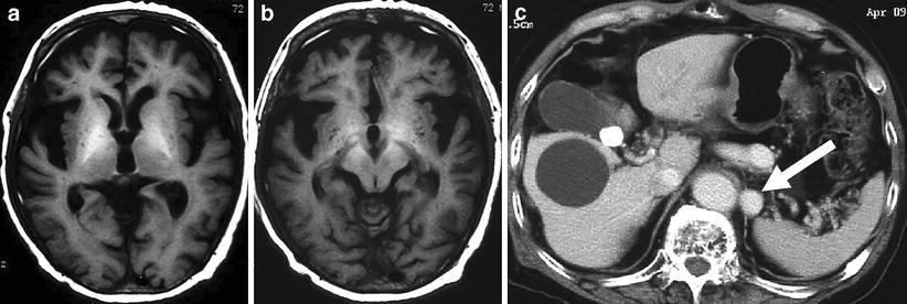 Manganese accumulation in the brain: MR imaging | SpringerLink