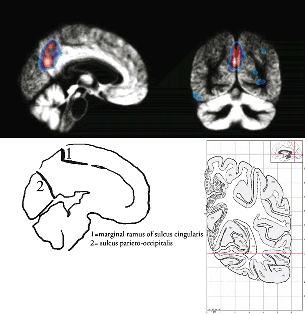 Precuneus atrophy in early-onset Alzheimer’s disease: a morphometric ...
