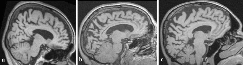 Precuneus atrophy in early-onset Alzheimer’s disease: a morphometric ...