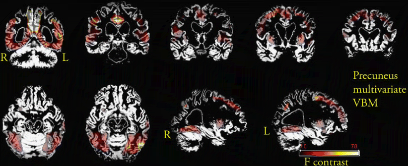 Precuneus atrophy in early-onset Alzheimer’s disease: a morphometric ...