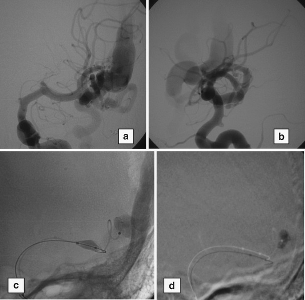 Transarterial balloon-assisted glue embolization of high-flow ...