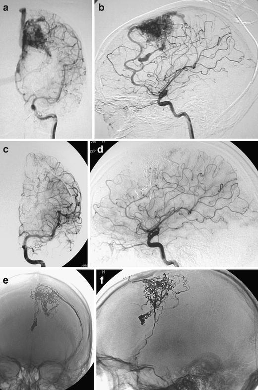 Curative embolization of cerebral arteriovenous malformations (AVMs ...