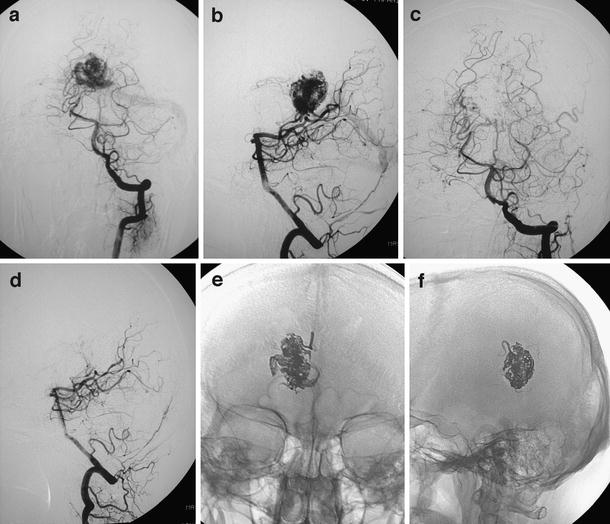 Curative Embolization Of Cerebral Arteriovenous Malformations Avms