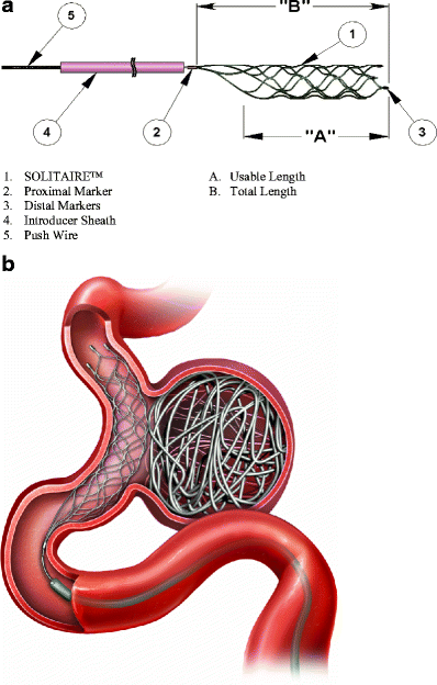 Coil embolization of anterior circulation aneurysms supported by the ...