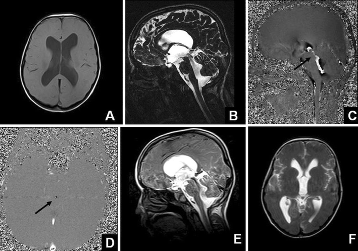 Phase-contrast MRI and 3D-CISS versus contrast-enhanced MR ...