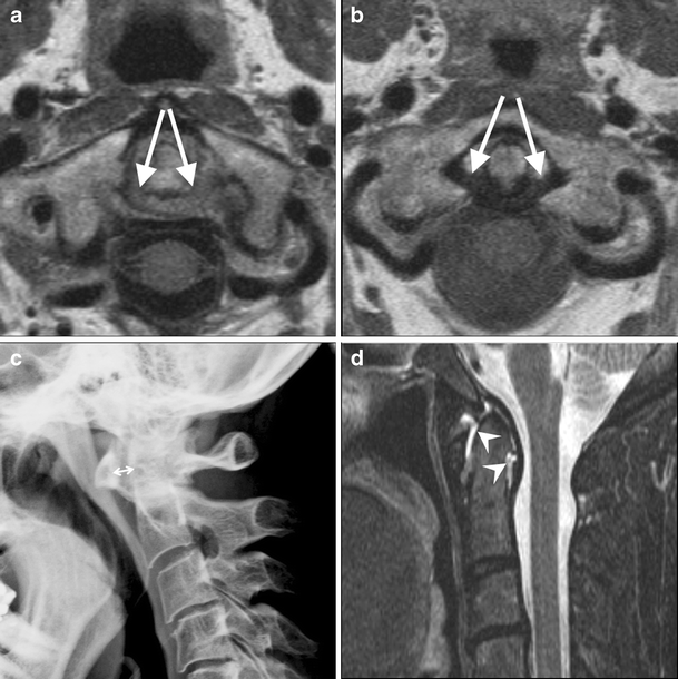 MRI of the transverse and alar ligaments in rheumatoid arthritis ...