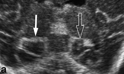 Hippocampal development at gestation weeks 23 to 36. An ultrasound ...