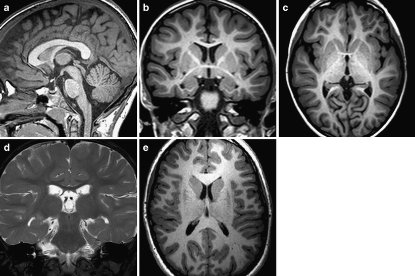 The corpus callosum, the other great forebrain commissures, and the ...