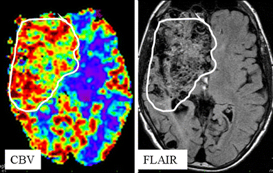 PWI-MRI and contrast extravasation in brain AVM help to estimate ...
