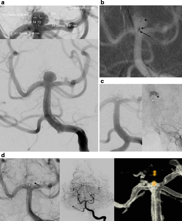 The Woven EndoBridge Cerebral Aneurysm Embolization Device (WEB II ...