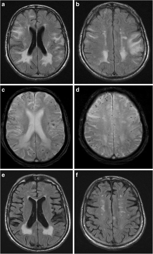Cerebral microbleeds: a guide to detection and clinical relevance in ...