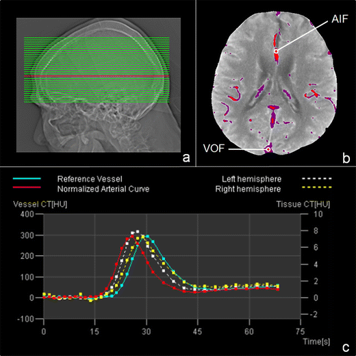 Whole-brain CT perfusion: reliability and reproducibility of volumetric ...