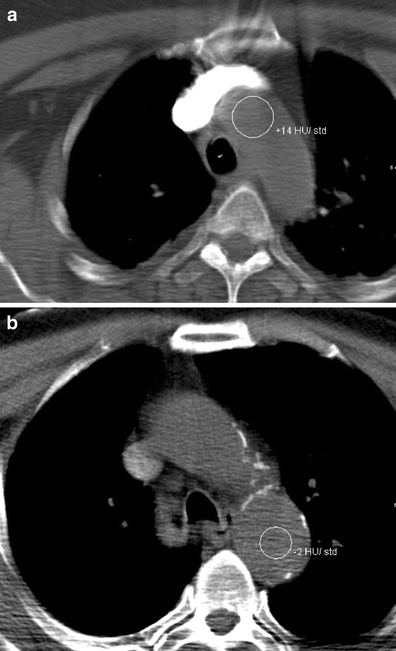 Effect of region-of-interest placement in bolus tracking cerebral ...