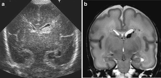 Imaging the premature brain: ultrasound or MRI? | SpringerLink