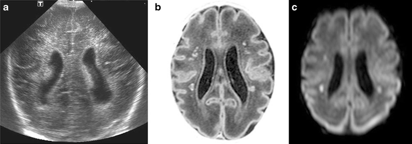 Imaging the premature brain: ultrasound or MRI? | SpringerLink