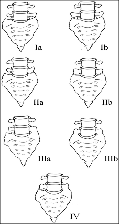 Lumbosacral transitional vertebra and S1 radiculopathy: the value of ...