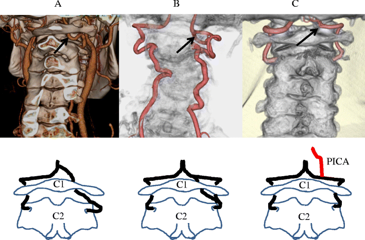 Vertebral artery variations and osseous anomaly at the C1-2 level ...