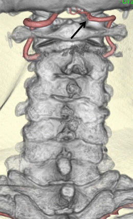 Vertebral artery variations and osseous anomaly at the C1-2 level ...