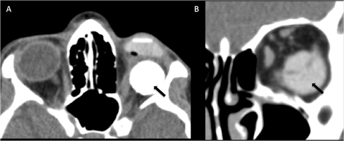 Post-operative orbital imaging: a focus on implants and prosthetic ...