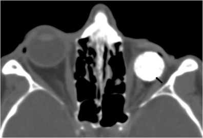 Post-operative orbital imaging: a focus on implants and prosthetic ...