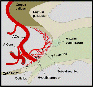 Subcallosal artery stroke: infarction of the fornix and the genu of the ...