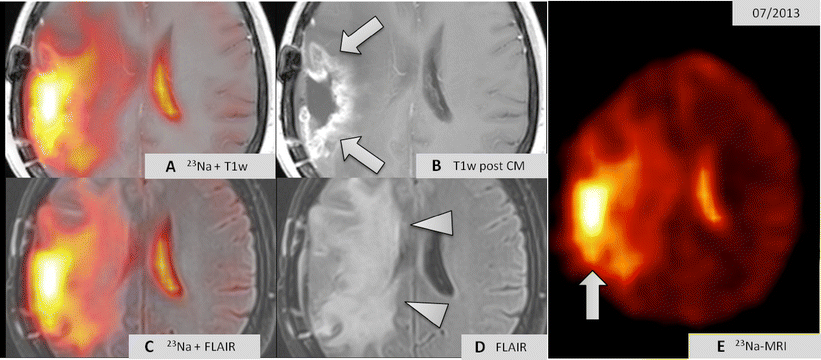 23Na-MRI of recurrent glioblastoma multiforme after intraoperative ...