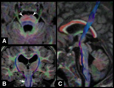Expanding the spectrum of congenital anomalies of the diencephalic ...