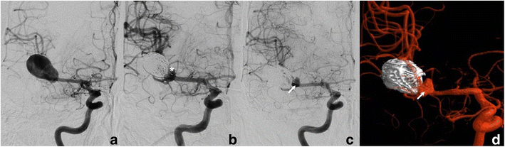 Woven Endobridge (WEB) device for endovascular treatment of complex ...