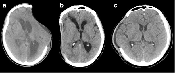 Radiological signs of the syndrome of the trephined | SpringerLink