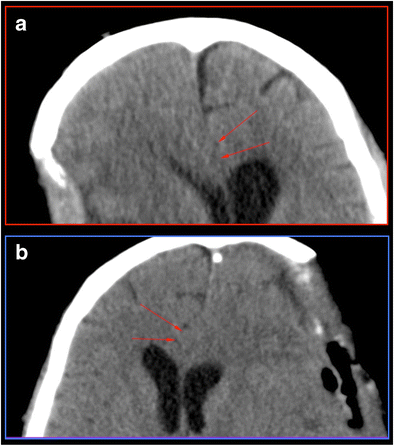 Radiological signs of the syndrome of the trephined | SpringerLink