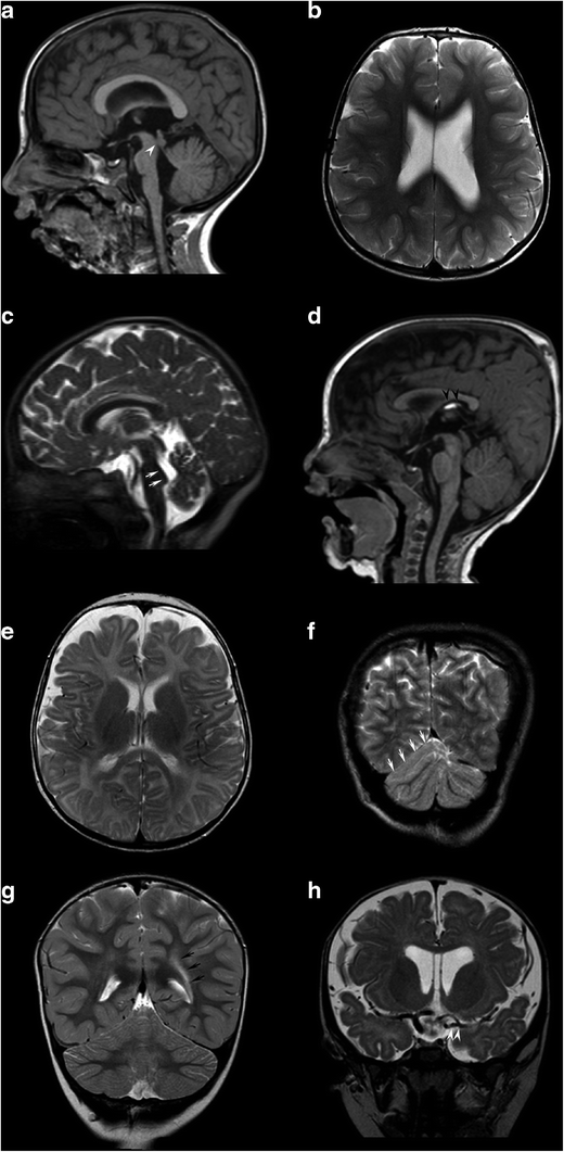 Oculo-auriculo-vertebral spectrum: going beyond the first and second ...