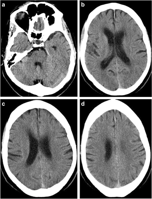 Imaging of cerebral ischemic edema and neuronal death | SpringerLink