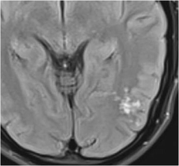 Multinodular and vacuolating neuronal tumor in an adolescent with ...