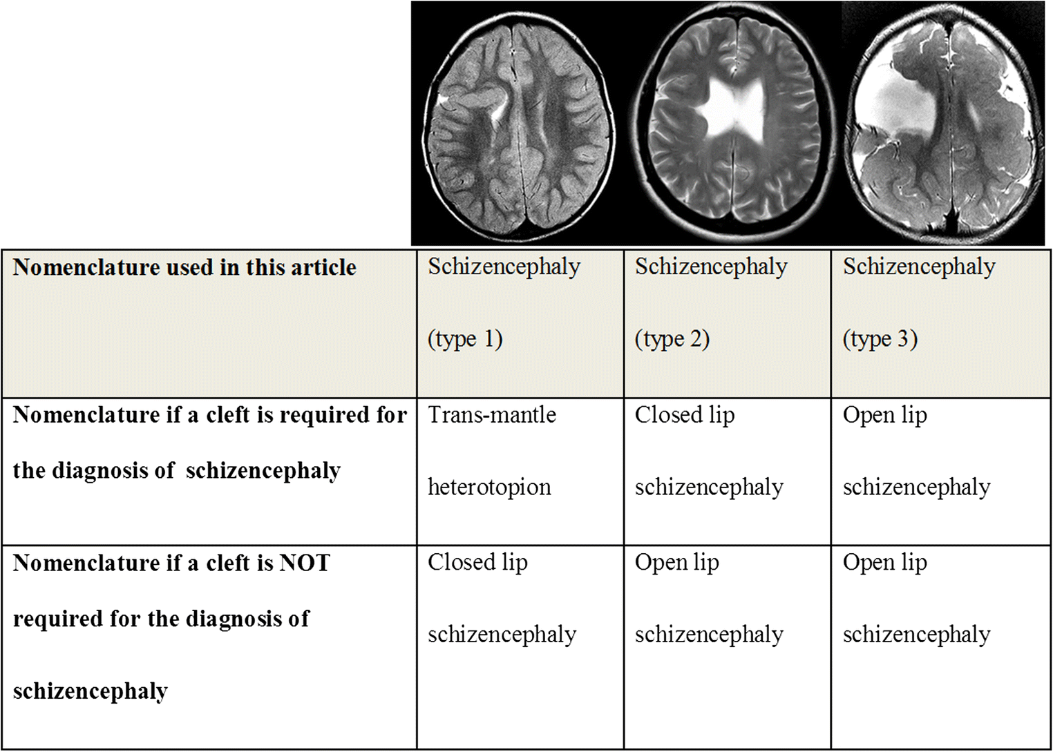 Schizencephaly revisited | SpringerLink